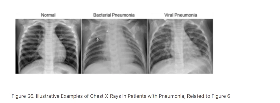 ML Beginner's Guide To Build Pneumonia Detection Model ML Beginner's Guide To Build Pneumonia Detection Model